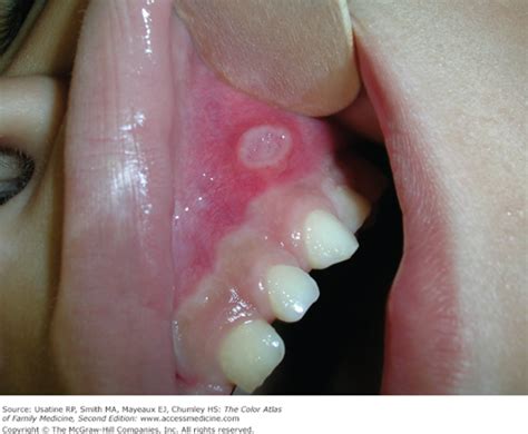 Aphthous Ulcer Basicmedical Key