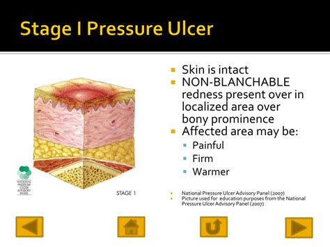 Ppt Pressure Ulcers In The Critically Ill Patient Powerpoint
