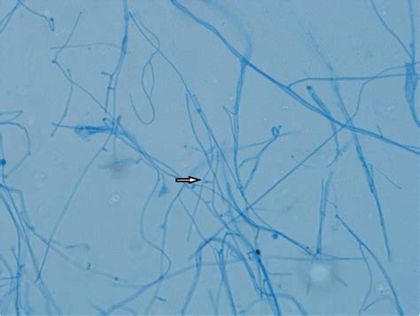 Fever Of Unknown Origin Secondary To Pulmonary Histoplasmosis In