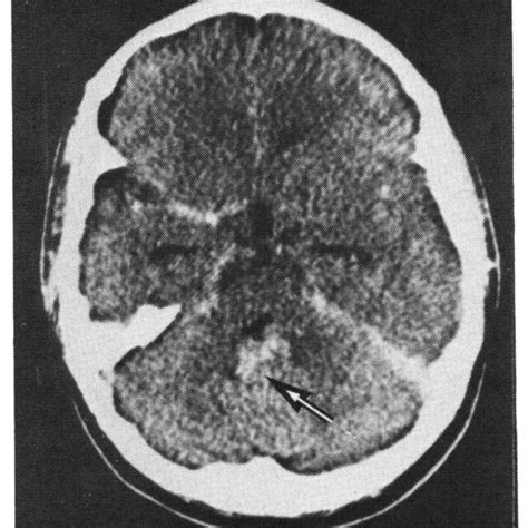 Pdf Positional Vertigo And Nystagmus Of Central Origin