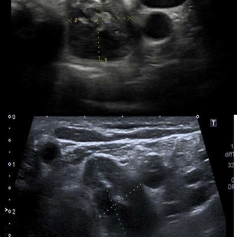 Ultrasonography Showing A Well Defined Hypoechoic Lesion Measuring