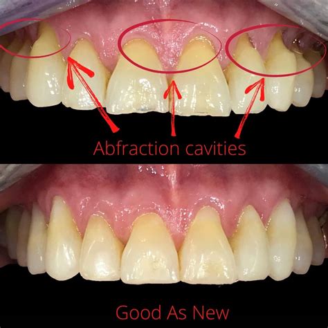 Fine Beautiful Tips About How To Fix Sensitive Teeth Strangertourist2