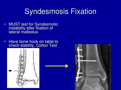 Ppt Ankle Fractures Powerpoint Presentation Free Download Id 6654288