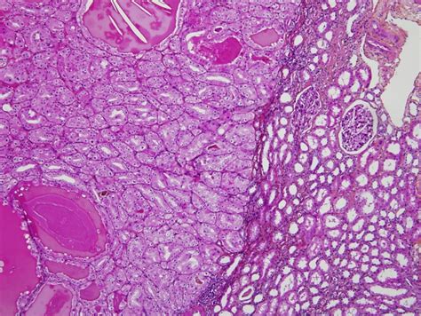 Pathology Outlines Hybrid Oncocytic Chromophobe Tumor
