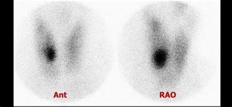 Nuclear Medicine Thyroid Uptake And Scan Top 3 Things To Know
