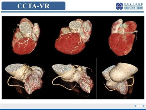 【ppt】主动脉窦瘤 影像ppt