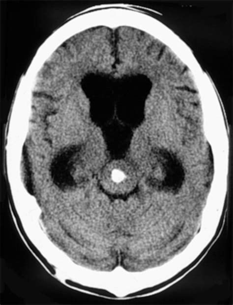 Midbrain Ct