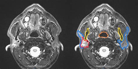 Parotid Cancer Center For Advanced Parotid Surgery Beverly Hills Ca