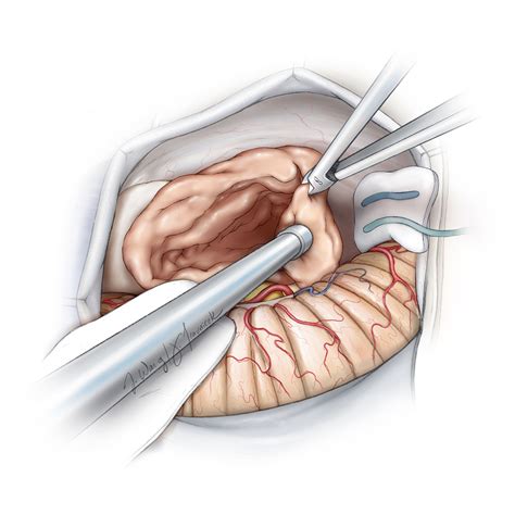 Retrosigmoid Approach The Neurosurgical Atlas By Aaron Cohen Gadol M D