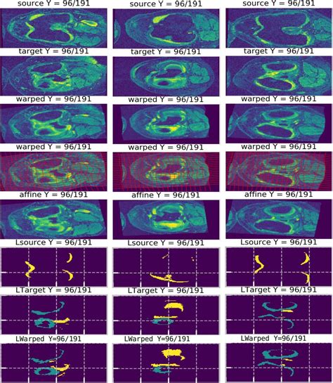 基于深度学习的单模医学图像配准综述（附voxelmorph配准实例） 程序员大本营