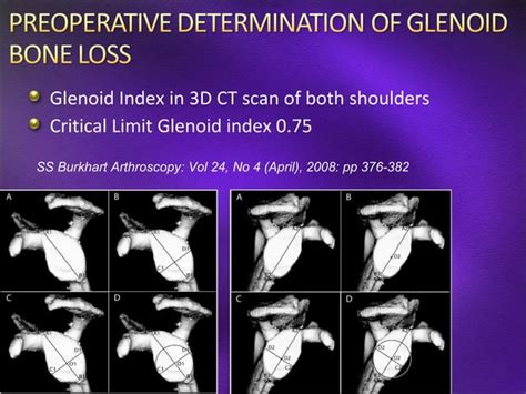 Humeral And Glenoid Bone Defects As Factors Ppt