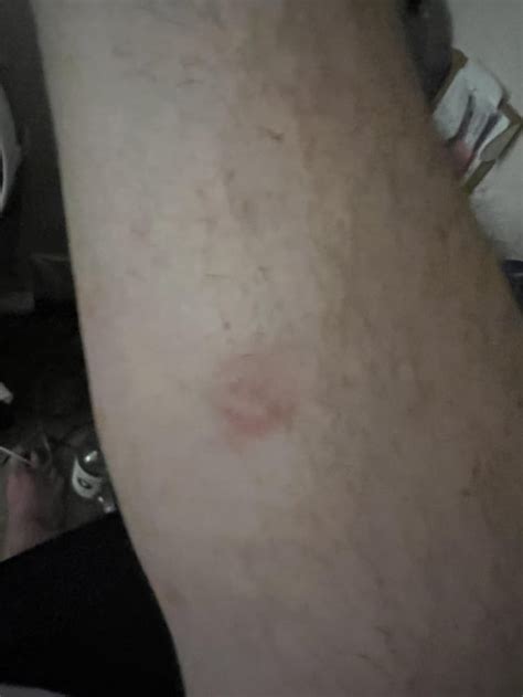 Rash Type Rdermatologyquestions