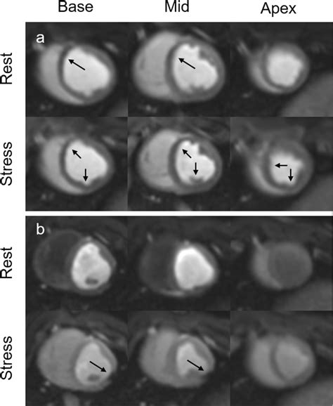 Gadolinium Enhanced Rest And Stress First Pass Perfusion Images Download Scientific Diagram