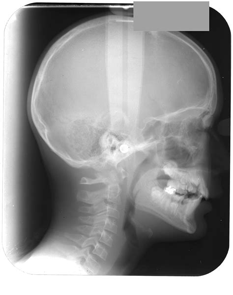 CVM BBox Detection Object Detection Dataset By Salihs Workspace
