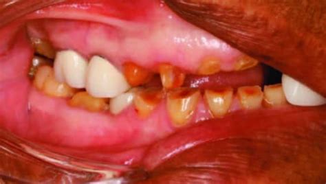 Occlusal Plane Correction Using Flowable Composite In A Maxillary Denture Decisions In Dentistry
