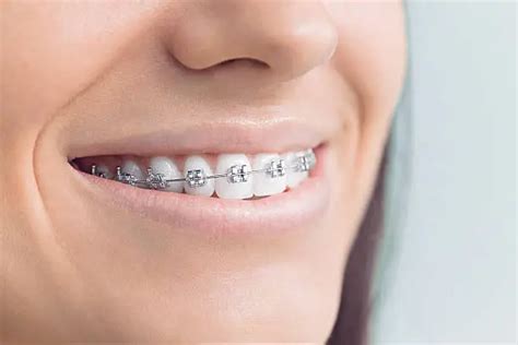 Traditional Braces 97dental