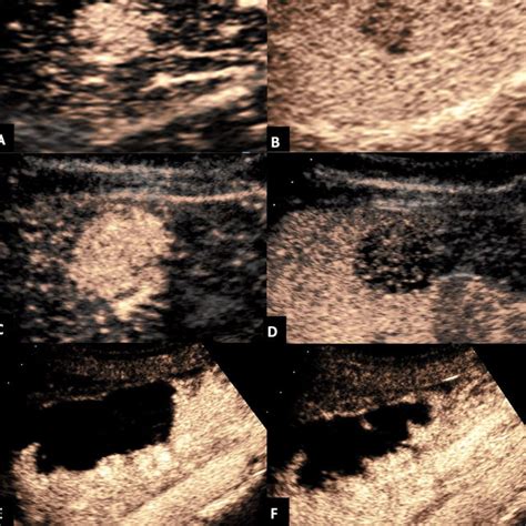 Pdf Contrast Enhanced Ultrasound Ceus Has Excellent Diagnostic