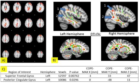 Lower Activation In Frontal Cortex And Posterior Cingulate Cortex Observed During Sex