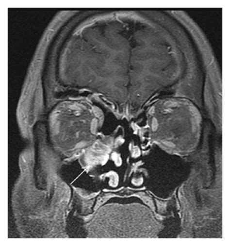 18 Year Old Male Presenting With Right Sided Proptosis And History Of Download Scientific