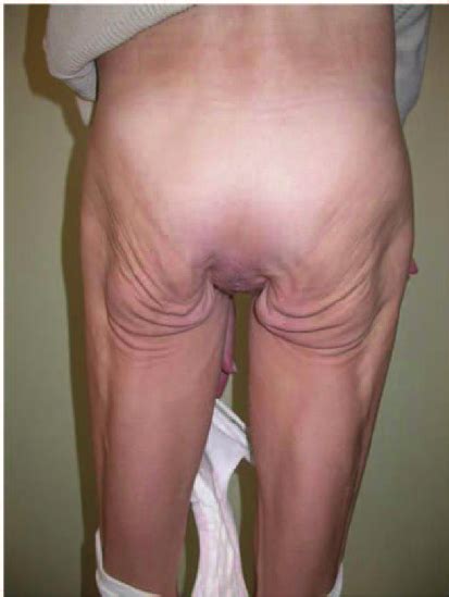 Female Patient 34 Year Old With Severe Buttock Lipoatrophy Download Scientific Diagram