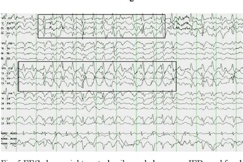 Figure 5 From Can Eeg Test Helps In Identifying Brain Tumor Semantic Scholar