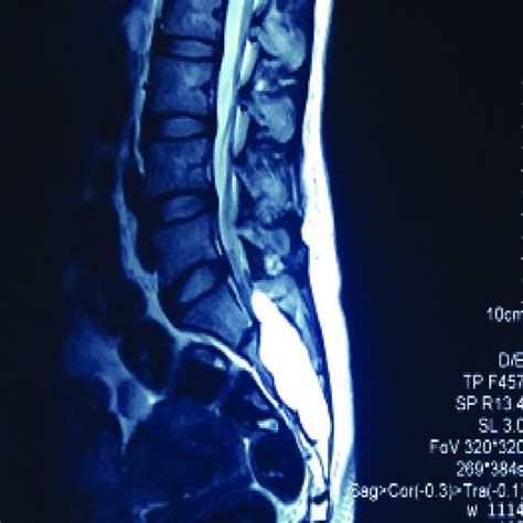 Pdf A Rare Huge Sacral Tarlov Cyst With Progressive Neurologic Deficit A Case Report