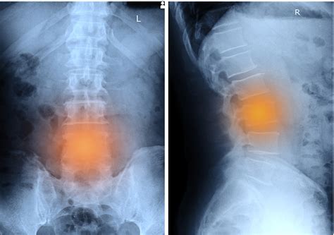 Exploring The Science Behind Spinal Decompression Therapy For Degenerative Disc Disease Blog