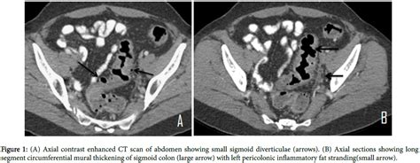 Journal Of Radiology Colosalpingeal Fistula Rare Complication Of