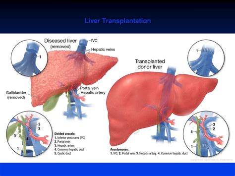 Ppt Liver Transplant Decompensated Cirrhosis Impact On Survival