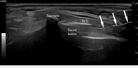 Ultrasound Guided Caudal Epidural Block Sagittal Plane Scl