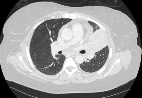 Faces Of Atelectasis Shape Lungs