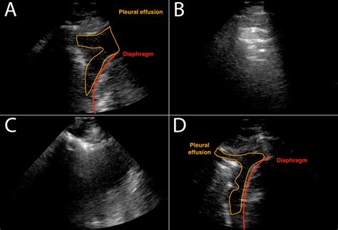 Automatic Deep Learning Based Pleural Effusion Classification In Lung