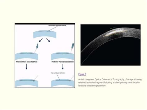 Just Smile Small Incision Lenticule Extraction Pptx Eye And Vision Conditions Diseases