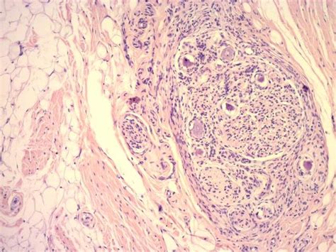 Testicular Teratoma In Gray Brocket Deer Mazama Gouazoubira Nervous