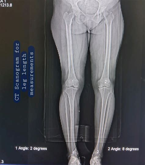 Pankaj Dahariya On Linkedin Ct Vascular Scanogram For Leg Length