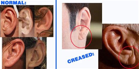 How To Get Rid Of Earlobe Creases Captions Graphic
