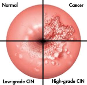 Diagnosing And Treating Abnormal Cervical Cells