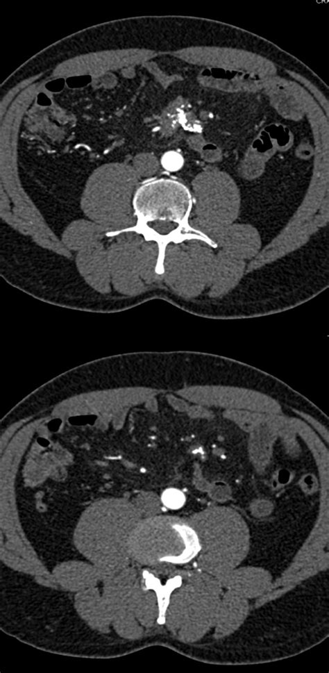 Gastrointestinal Learning Modules Ct Scanning