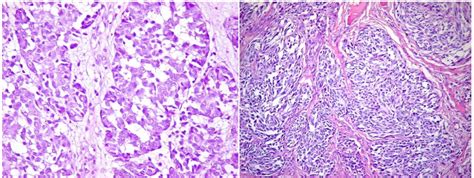 Figure 3 Amelanotic Vulvar Melanoma Case Report And