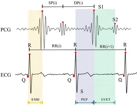 Machine Learning Based Cad Detection Using Integrated Ecg And Pcg