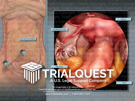 Endoscopic View Into The Female Pelvis Trial Exhibits Inc