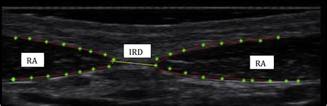 Effects Of Posture And Anatomical Location On Inter Recti Distance