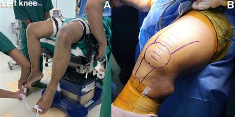 Quadriceps Tendon Repair