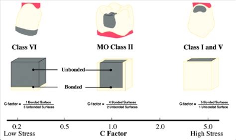 Week Class II Resin Composite Restoration Flashcards Quizlet