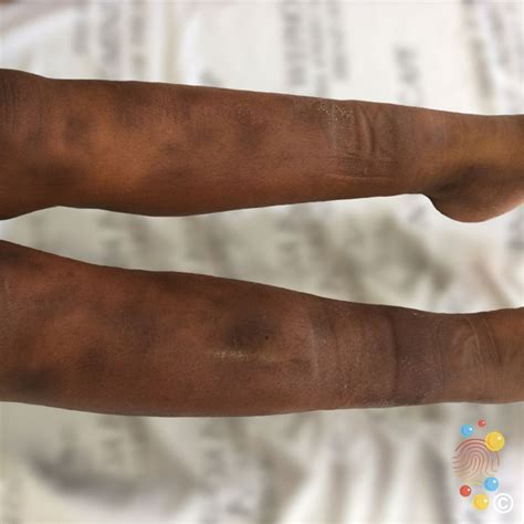 Erythema Nodosum Specialist