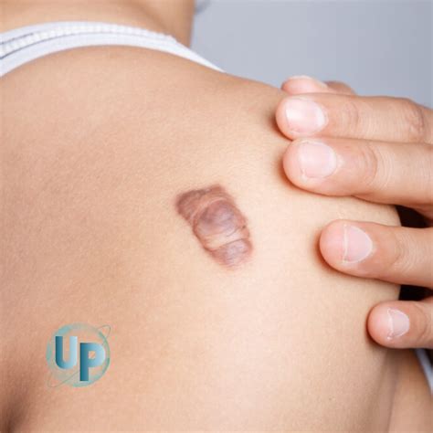 O Que é Queloide Universo Do Piercing