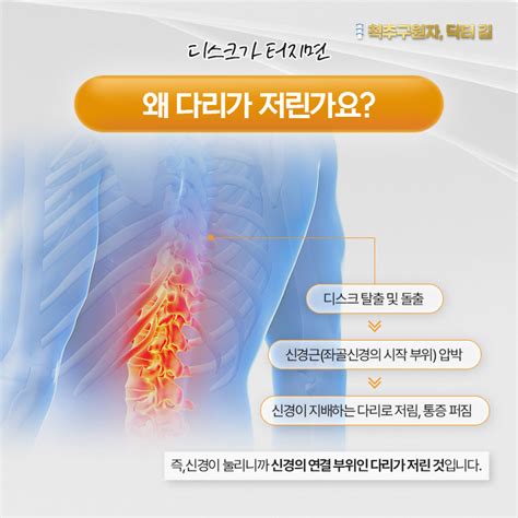 척추구원자 닥터 김 은평구 신경외과 불광역 신경외과전문의 ⊹ 디스크가 발병하면 다리가 저린 이유 ⠀ ⊹ 탈출하는 디스크 위치에 따라 나타나는 다양한 증상