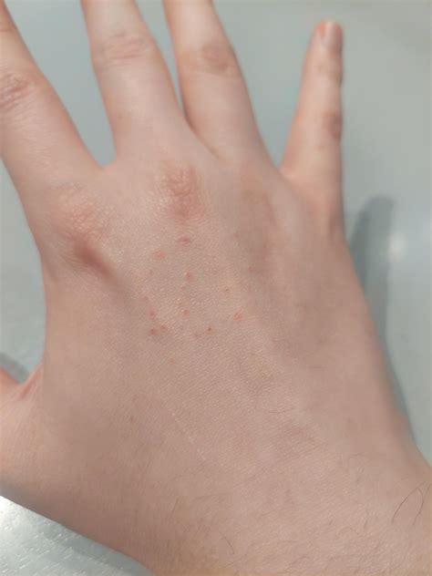 Anyone Else Deal With Chronic Hives R 30plusskincare