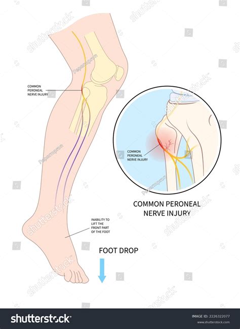 Common Fibular Nerve