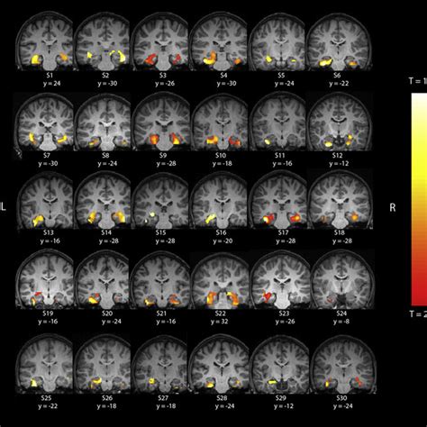One Sample T Test Of Mesial Temporal Lobe Activation In The Whole Group